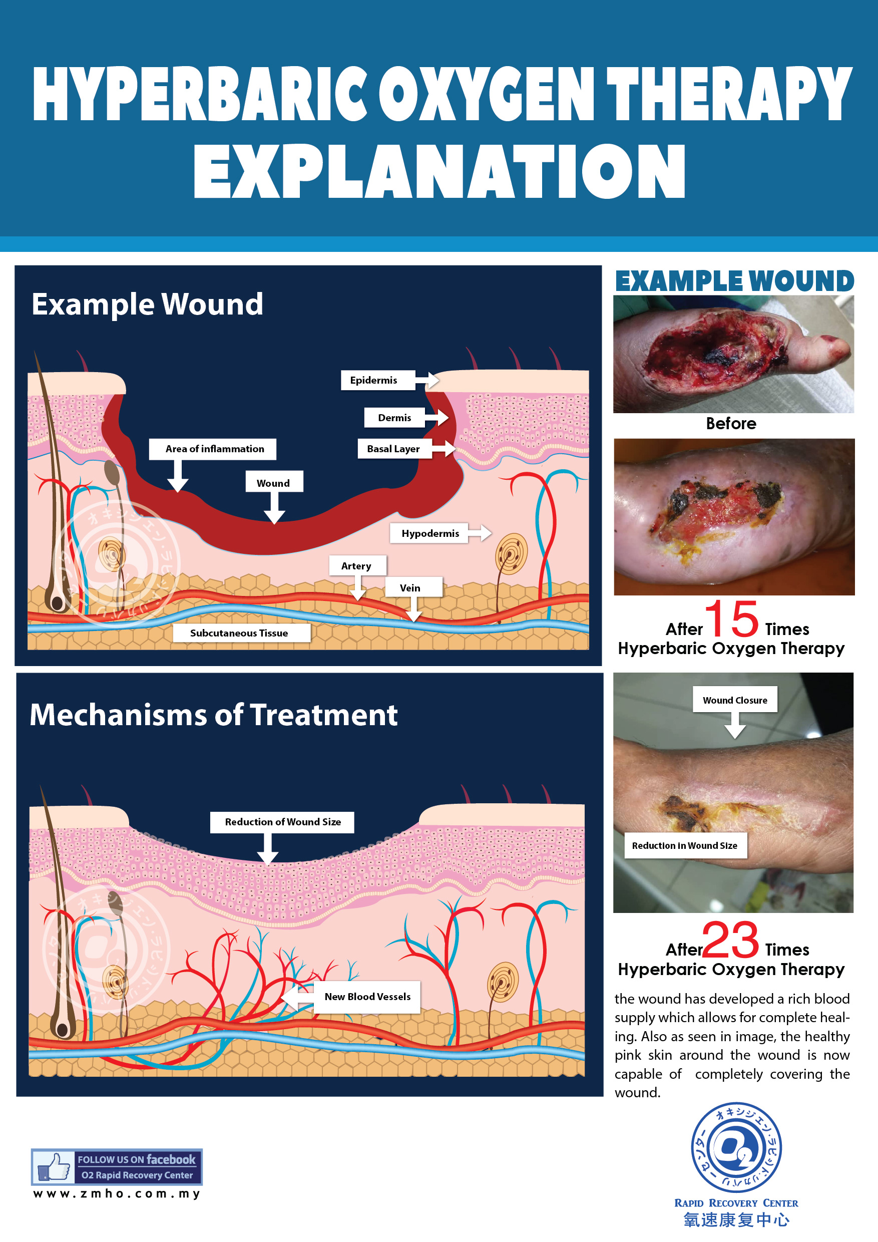 ZM Hyperbaric Oxygen Therapy | HBOT